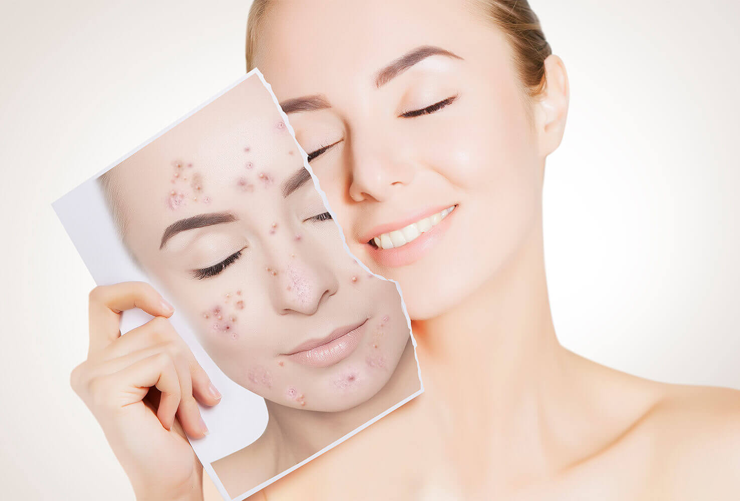 Adult acne, if you wanna get rid of this and get clear skin